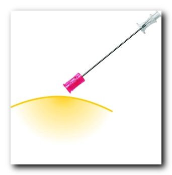 Safety Vascular Access Needles – ISIPS